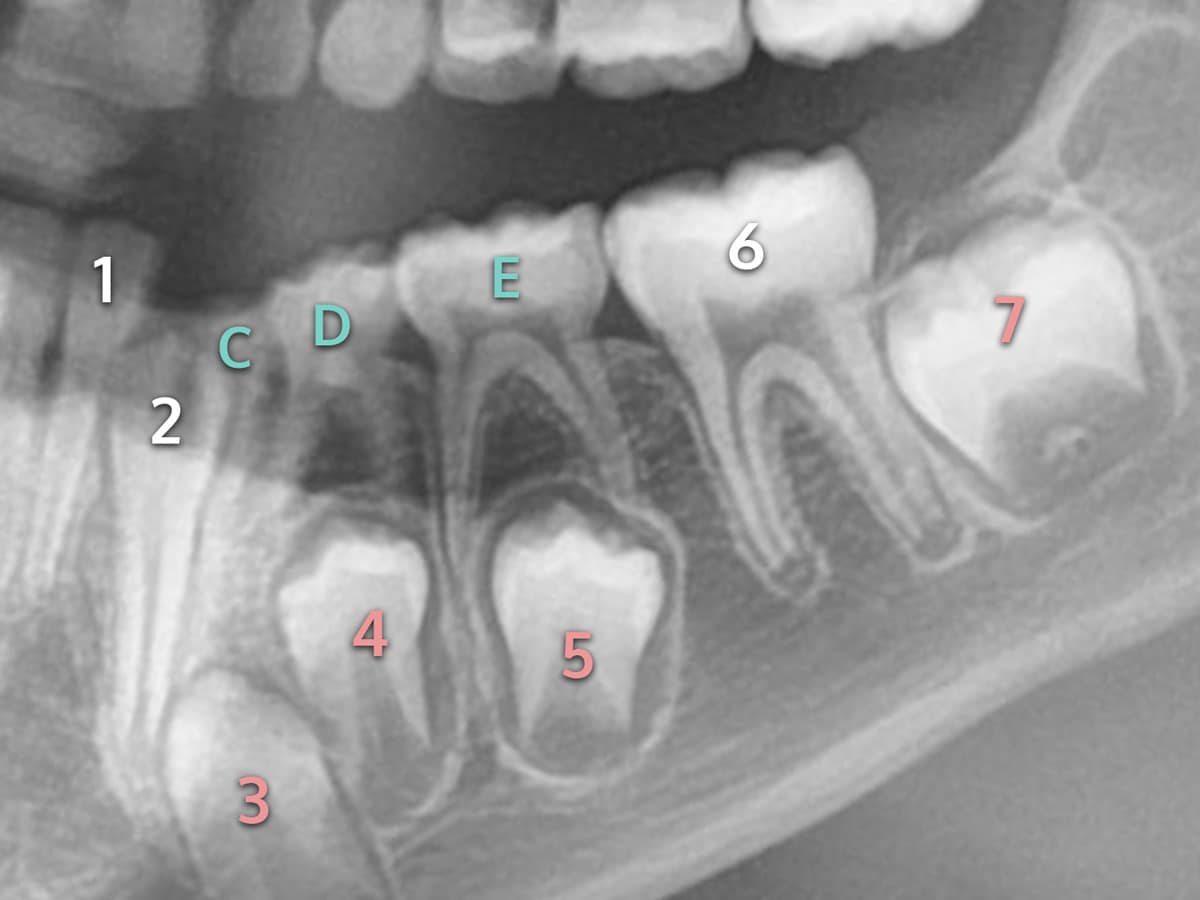 Parents’ FAQ about Erupting Permanent Teeth (Part 2) - Twinkle Family ...