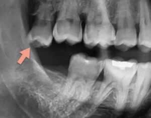 Is it Wise to Remove My Wisdom Teeth? - Medisave-Claimable for Surgery